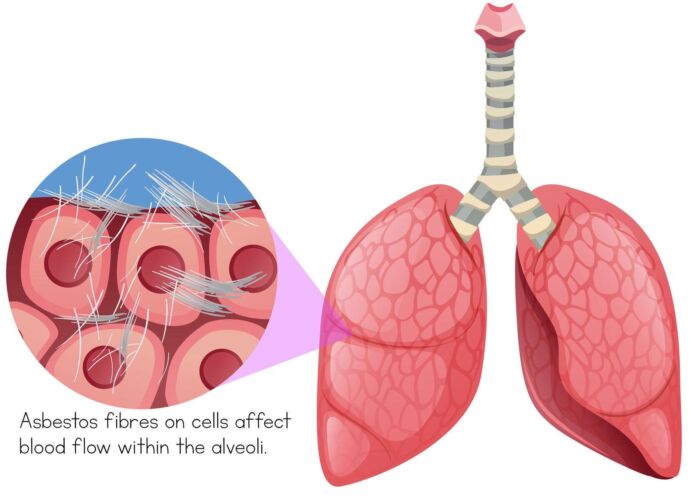What Does Asbestos Do to you? | Affects Of Exposure, Risk, Health Impact