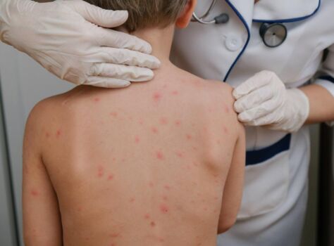 What is Chickenpox? | What is it, signs, symptoms and treatments