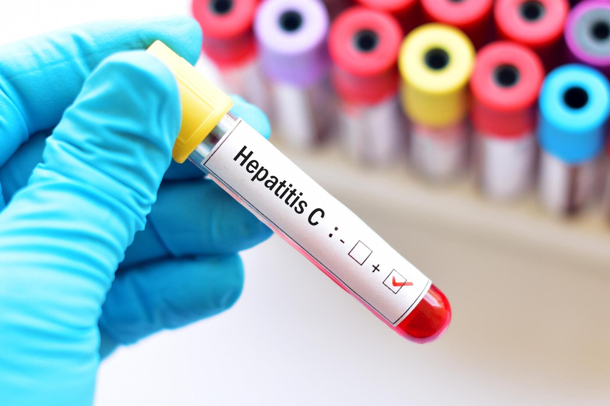 What is Hepatitis? | Signs, symptoms, diagnosing & treatment