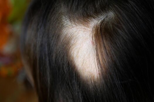 What is Alopecia? | Signs, symptoms, causes & treatment
